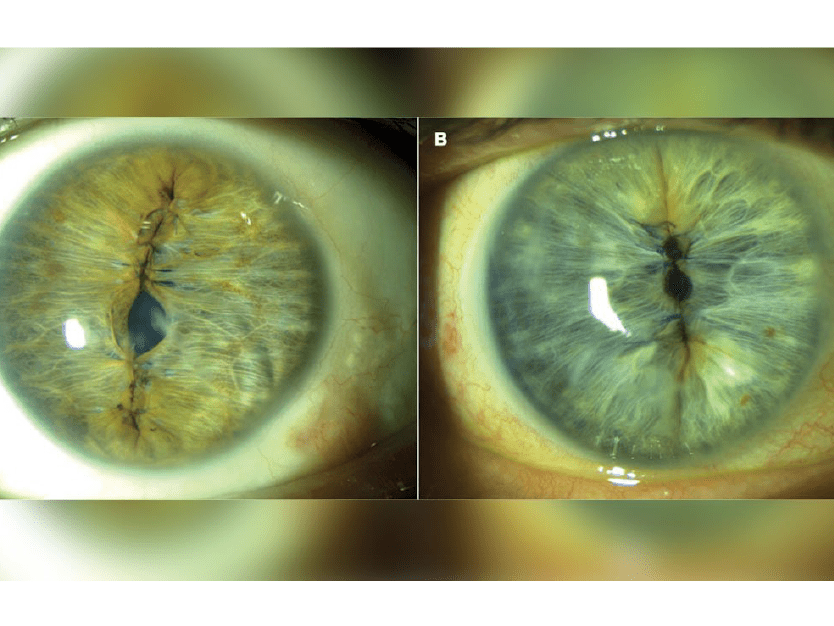 Refractive Surgery - Parker Cornea